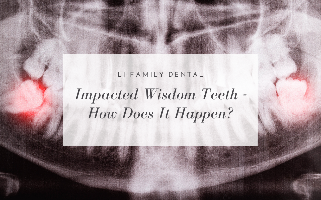 Understanding Impacted Wisdom Teeth: Causes and Solutions