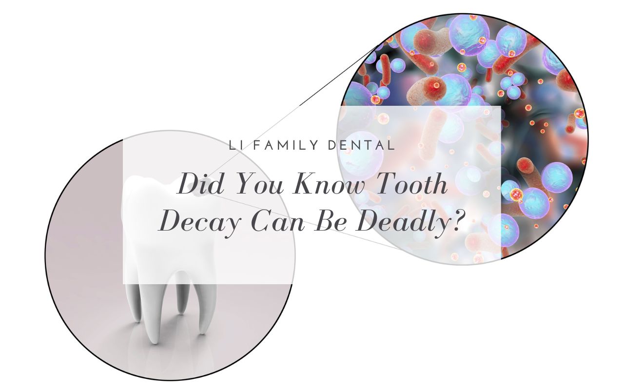 The Deadly Risks of Untreated Tooth Decay - Li Family Dental