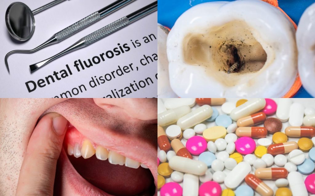 Decoding Brown Spots: Stain or Cavity? - Li Family Dental