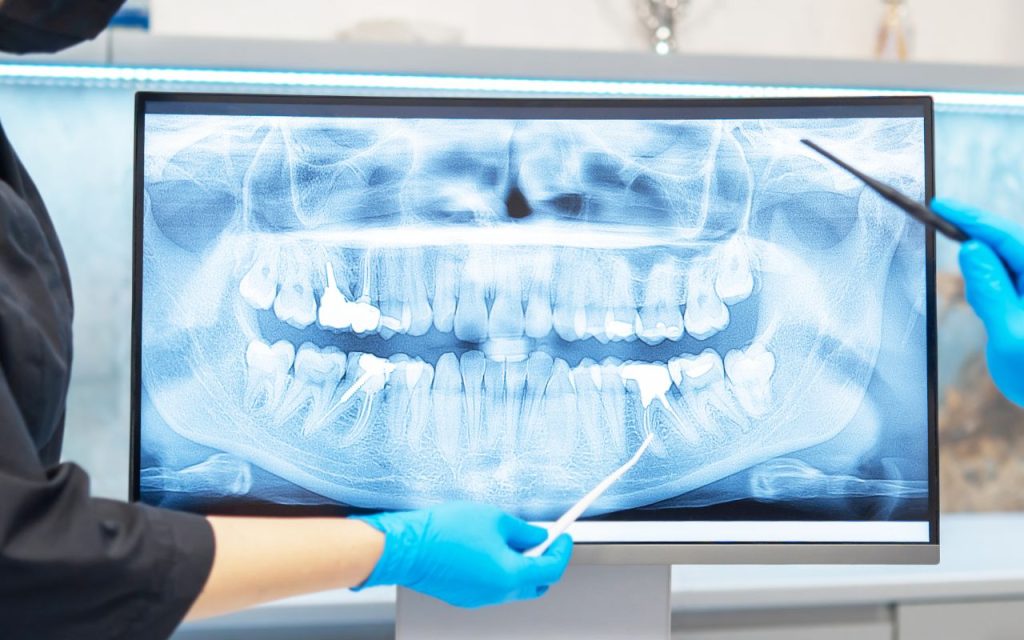 Dental X-Rays: Types, Uses, Importance - Li Family Dental
