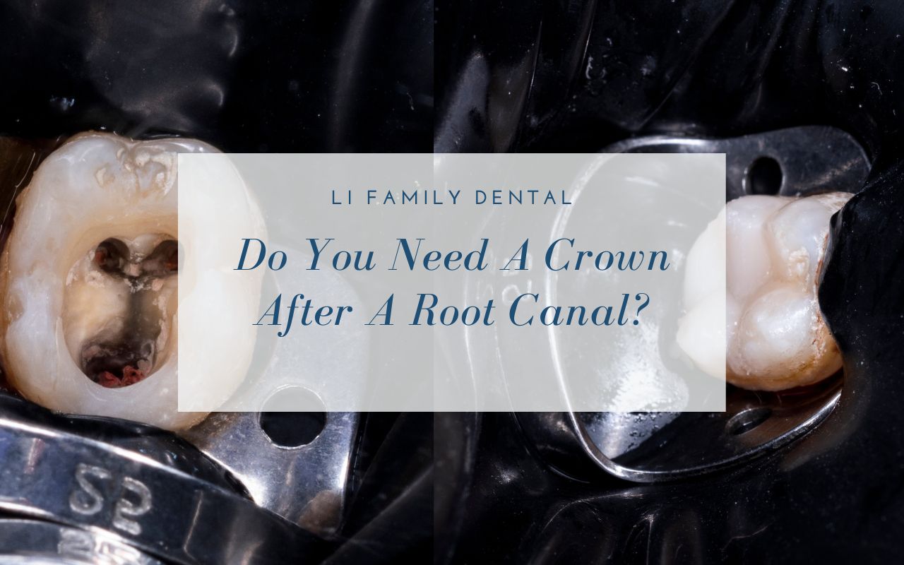 Crown After Root Canal: When & Why - Li Family Dental