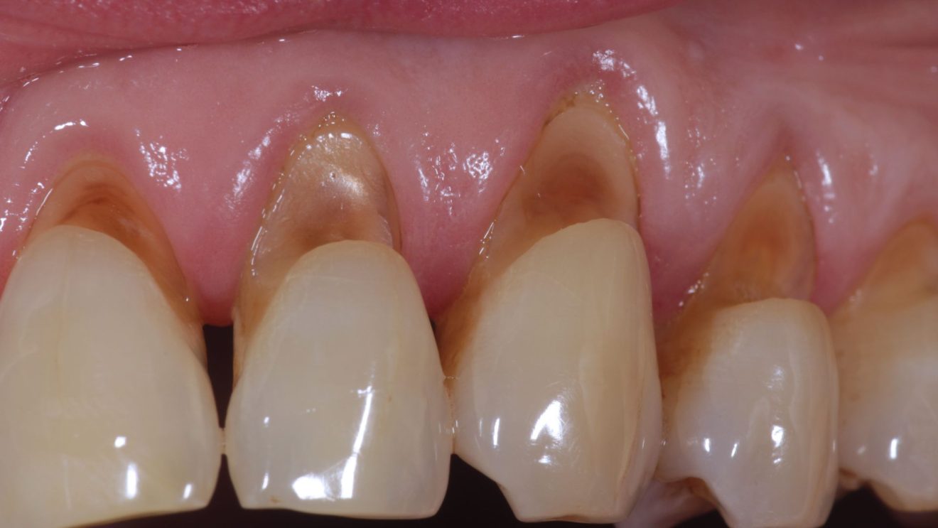 Prevent Dental Abrasion: Key Causes and Tips at Li Family