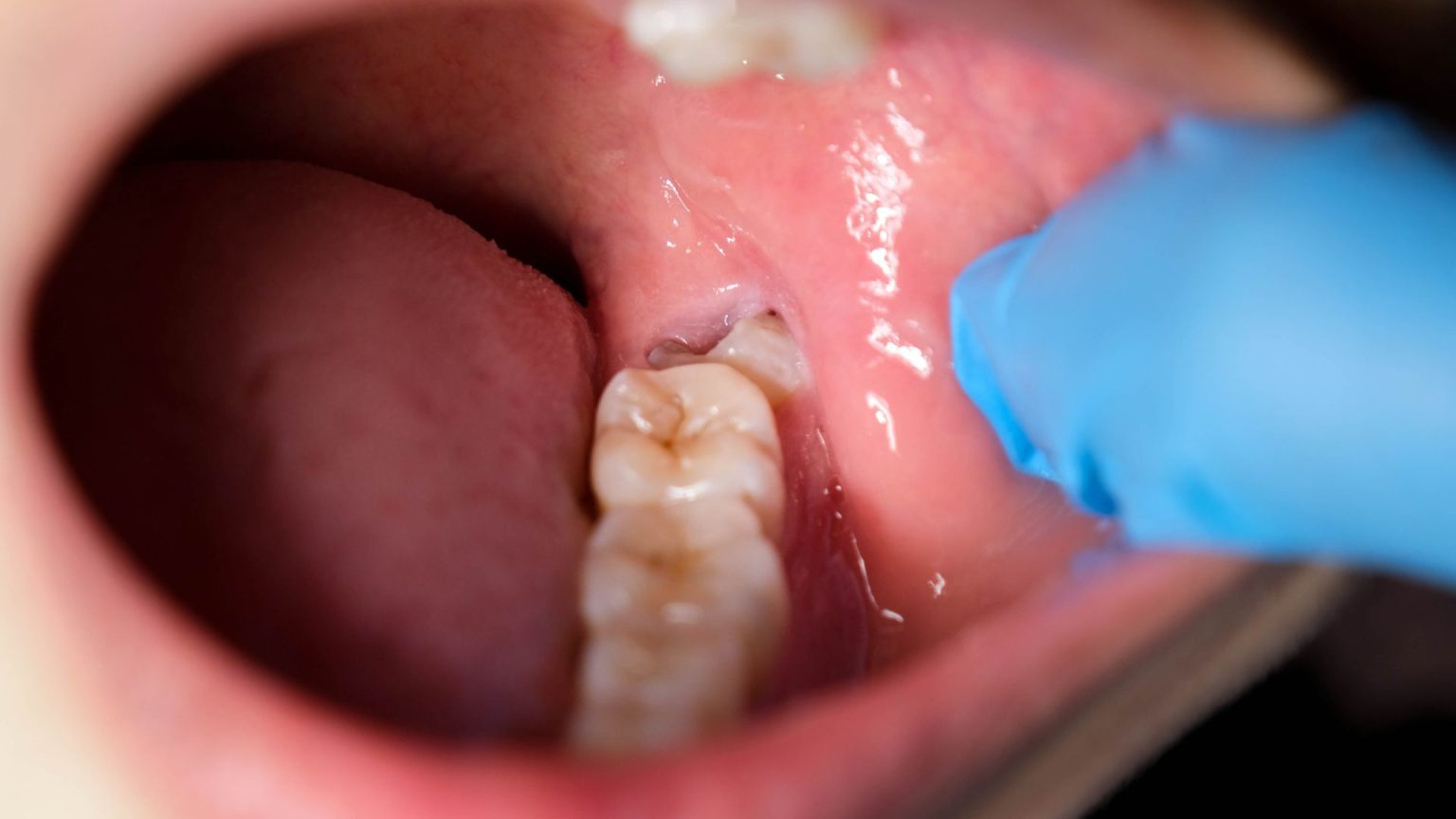 Pericoronitis Explained: Symptoms, Treatment, and Care Tips
