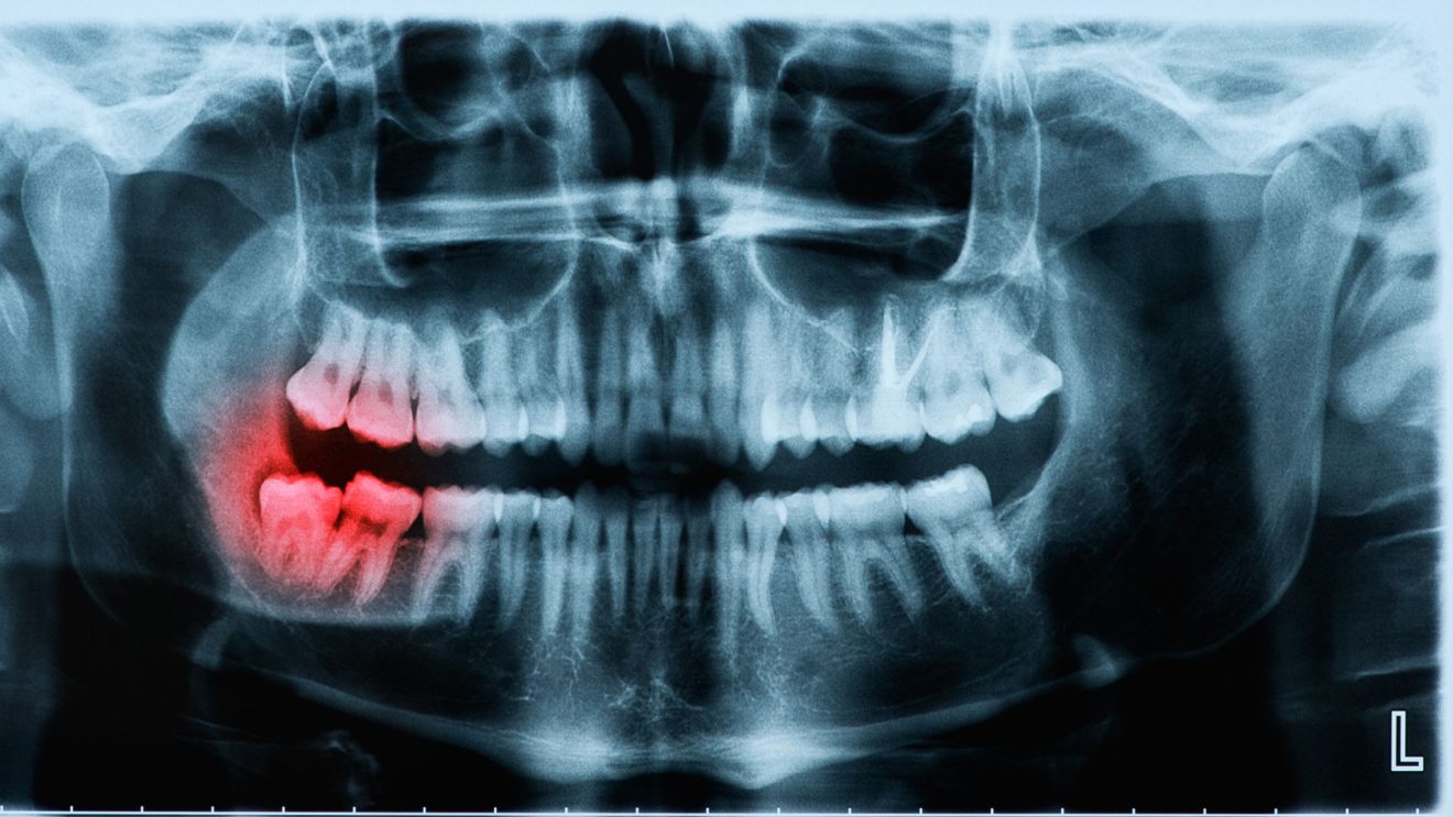 Pericoronitis Explained: Symptoms, Treatment, and Care Tips
