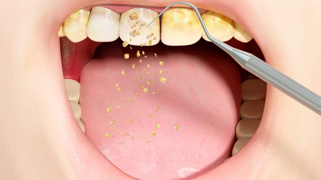 Dental Scaling & Root Planing: Li Family Dental's Guide