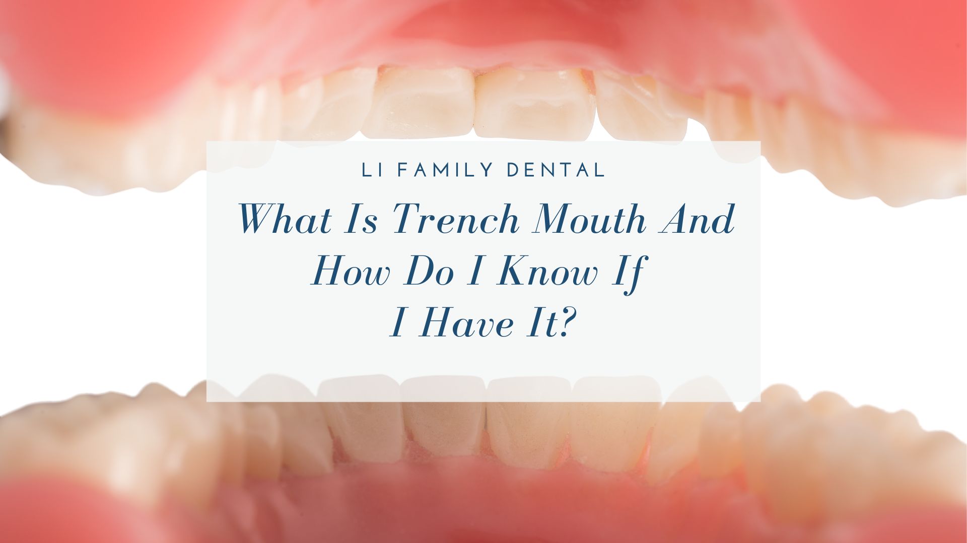 What Is Trench Mouth And How Do I Know If I Have It? - Li Family Dental ...